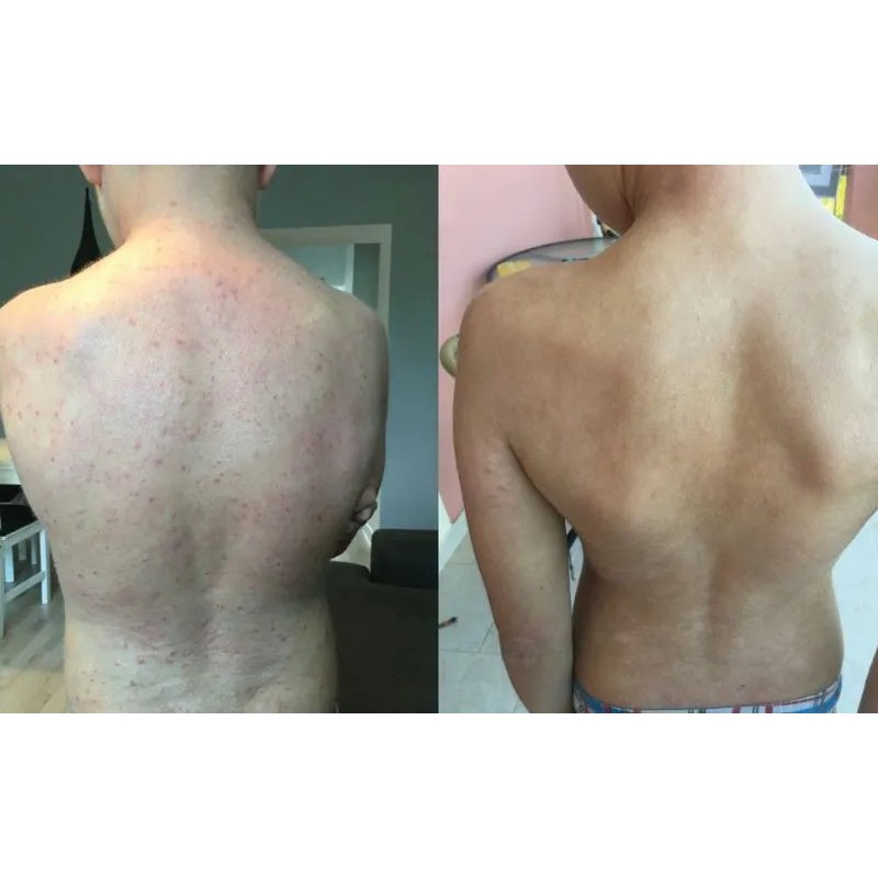 Specjalistyczna linia dla alergikówAllergoff Skin Barrier Emulsion ...